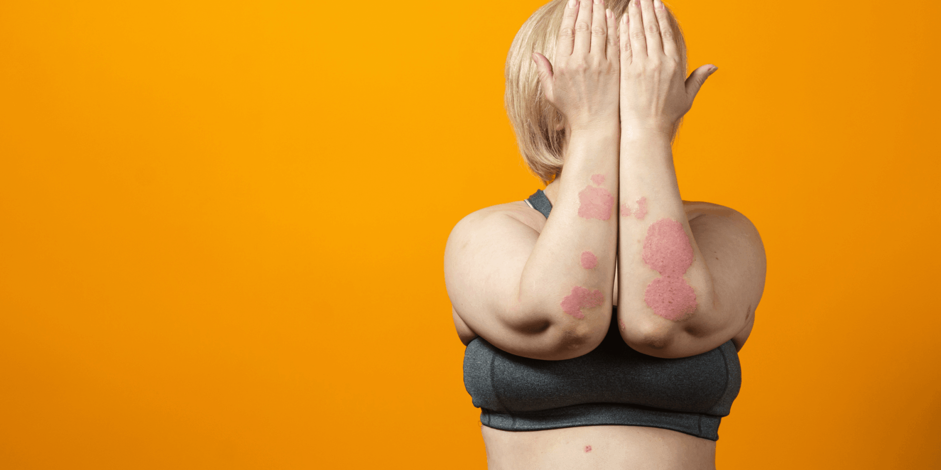 Gene discovery offers hope for those with psoriasis - Bonner General Health